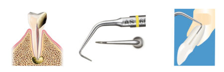 La résection apicale - Parodontologue Toulouse - Dentiste Toulouse