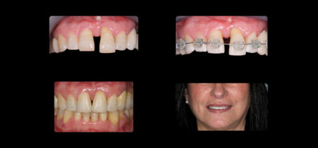 Thérapeutiques ortho-parodontales - Parodontologue Toulouse