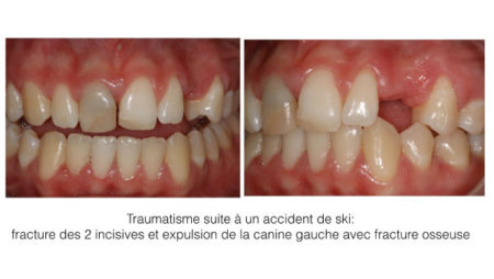 Les traumatismes dentaires et osseux - Dentiste Toulouse -Implant detaire